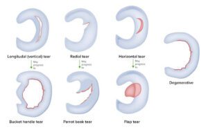 Meniscus Injury | Any Stage Physiotherapy and Sports Medicine